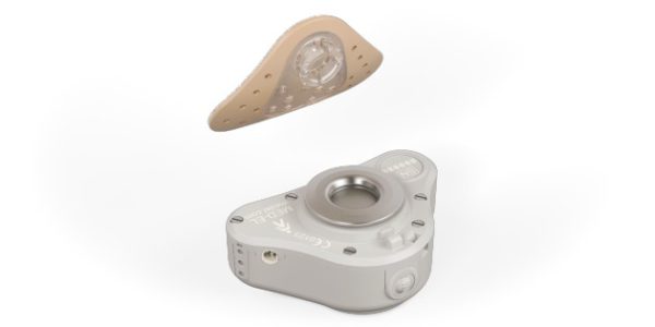 Le système à conduction osseuse ADHEAR de Med-El désormais ...